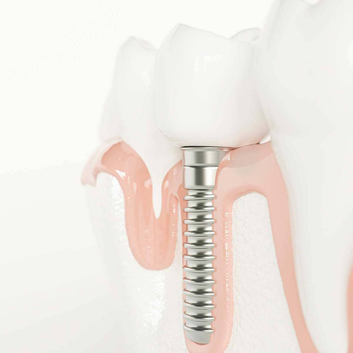 Feste Zähne - Zahnärzte City Süd