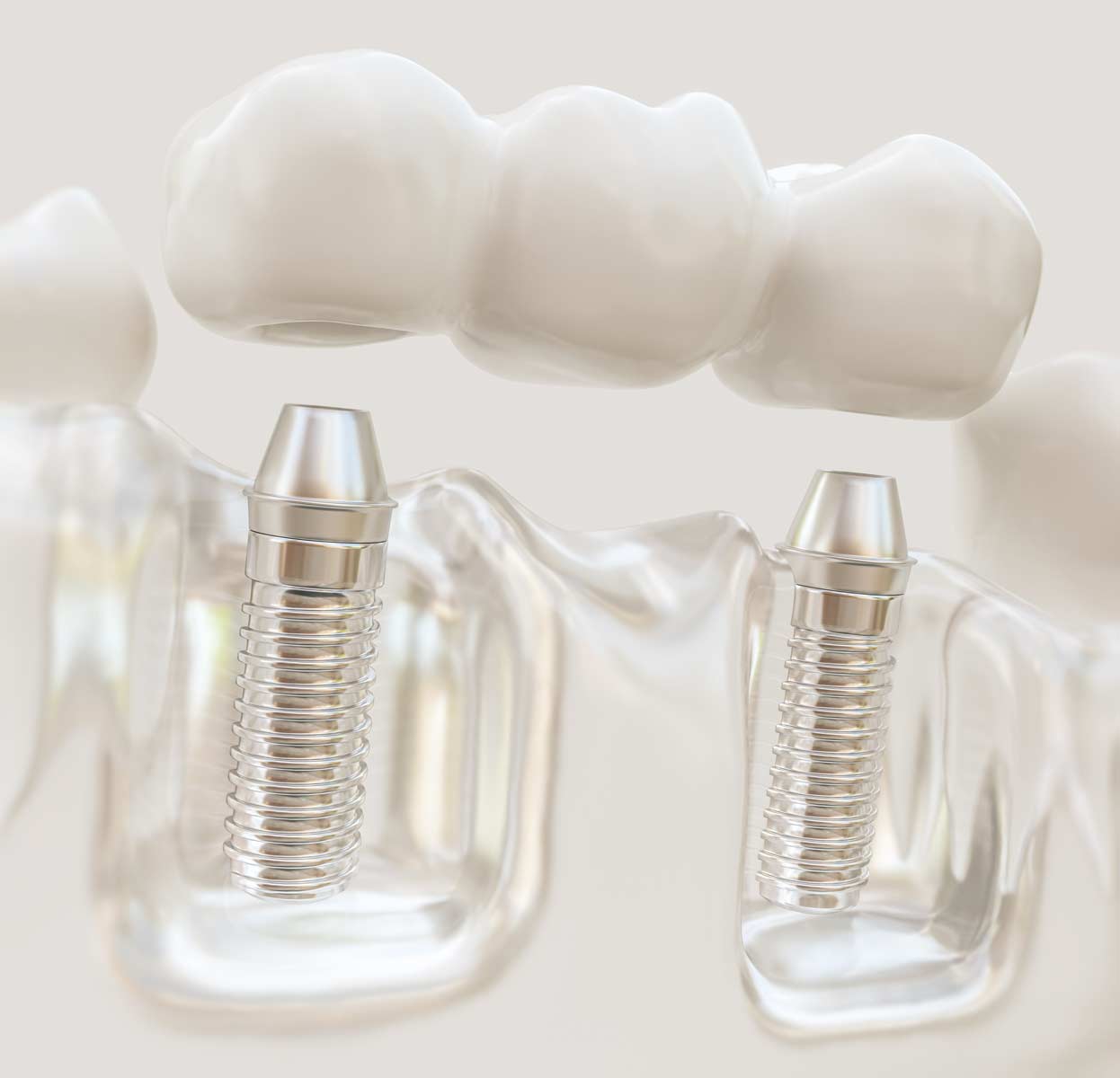 Feste Zähne - Zahnärzte City Süd